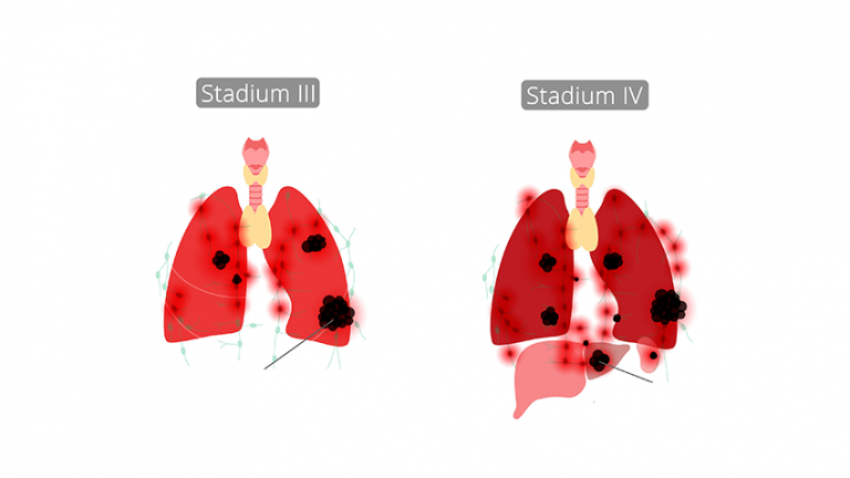 Staging einer Lungenkrebsdiagnose